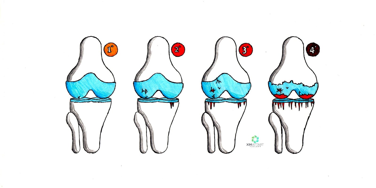Condropatia femoro-rotulea – TUTTE LE SOLUZIONI A CONFRONTO – Trattamix